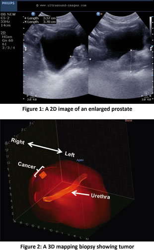 MRI Prostate Mapping | Colorado CyberKnife